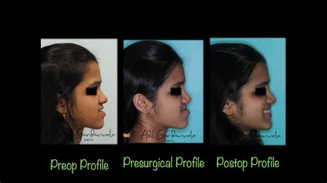 Mandibular Setback Surgical Management Of A Prognathic Mandible Youtube