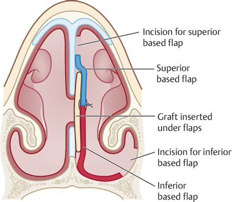 Unilateral Mucosal Advancement Flap Ento Key