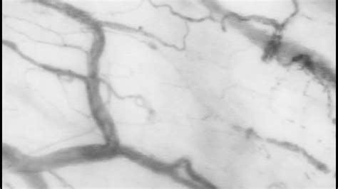 Sublingual Microcirculation In Mis C During The Acute Phase And Follow