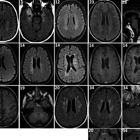 Mri Brain Findings Images Are All Axial T2 Flair Except Last Panel