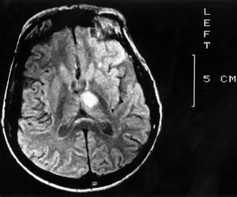 Diencephalic Amnesia And Apraxia After Left Thalamic Infarction