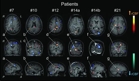 Subtraction Spect Coregistered To Mri Siscom Patient 7 Presented