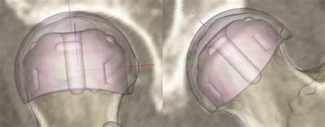 Case Reports Ceramic Hip Resurfacing Implants