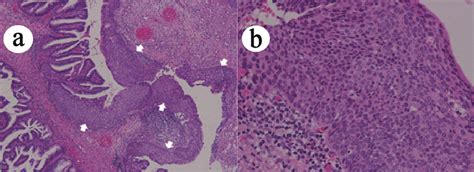 Cin3 Coexisted With Adenocarcinoma A Cin3 Lesion Indicated By Download Scientific Diagram
