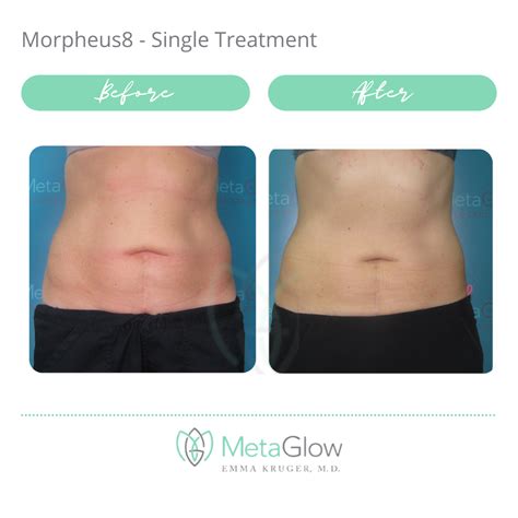 Morpheus 8 Treatment For Face And Body Metaglow