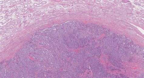 Sertoli Cells Archives Ottawa Atlas Of Pathology