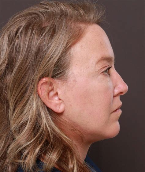 Facelift Deep Neck Contouring And Pre Jowl Chin Implant By Dr Thompson Utah Facial Plastics