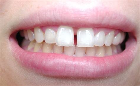 Gap Teeth Even28 Dentist Search Engine