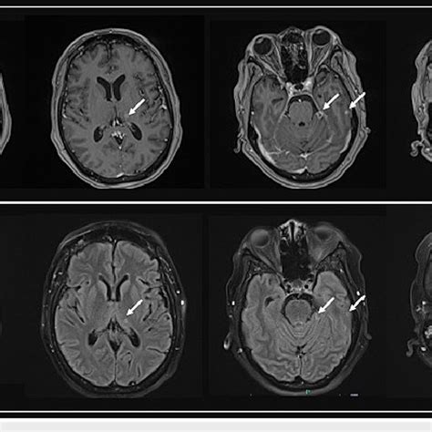 Mri Of The Brain With And Without Contrast Download Scientific Diagram