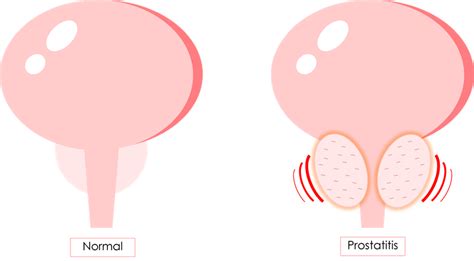 Prostatitis And Pelvic Pain Glossy Magazine