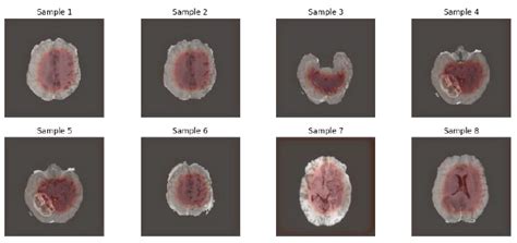 3d U Net For Brain Tumour Segmentation Issn 1678 0817 Qualis B2