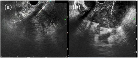A Endoscopic Ultrasound‐guided Fine‐needle Biopsy From The Second