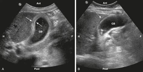 Ultrasonography Understanding The Principles And Its Uses In Abdominal
