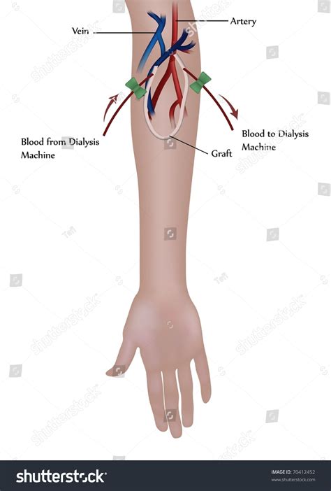 Procedimiento De Hemodiálisis Vectorial Utilizado Para Vector De