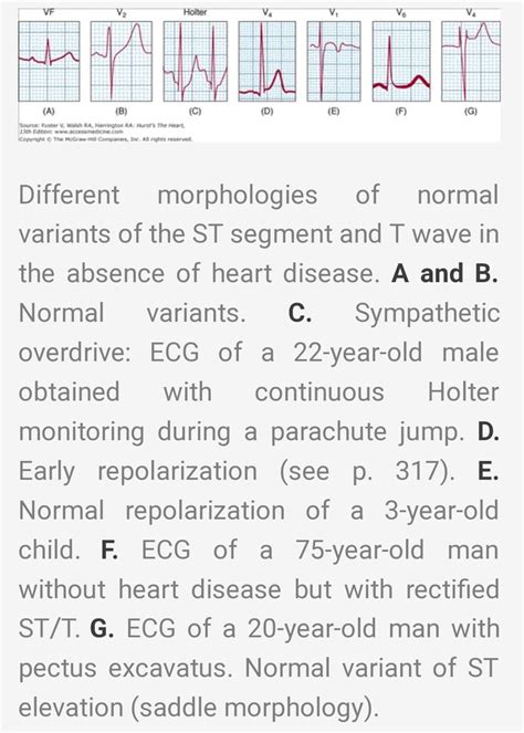 Pr Interval Normal Range Callumgroberger