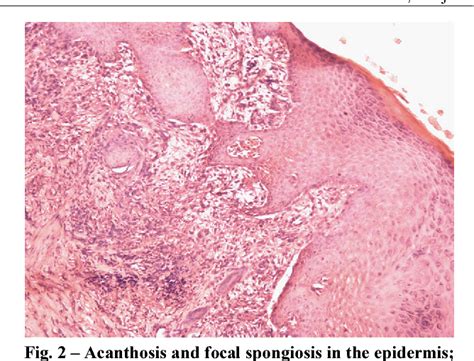 Figure 2 From Atypical Pyoderma Gangrenosum In A Patient With