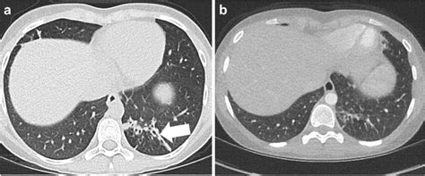 Images In A 12 Year Old Girl With Common Variable Immunodeficiency A Download Scientific