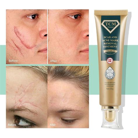 Silicone Scar Ointment 30g Moisturizing Scar Cream For Smooth