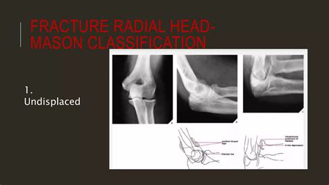 X Ray Of Elbow Joint Pptx