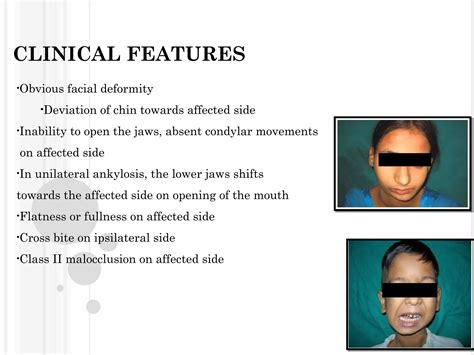Tmj Ankylosis Ppt