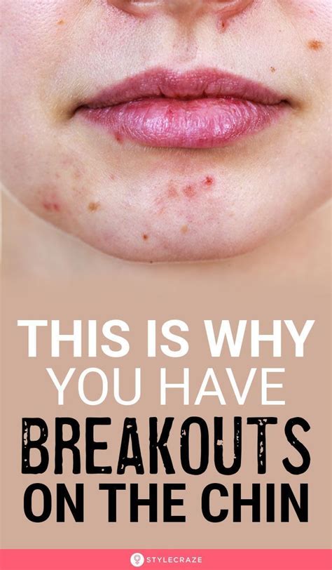 Do You Have Regular Breakouts On Your Chin Here S What It Really Means