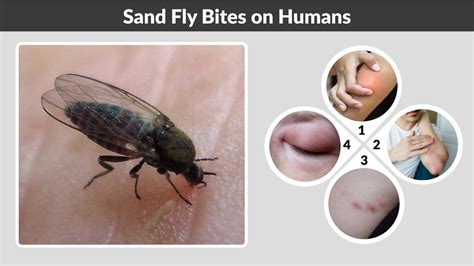 Sand Fly Bites On Humans Symptoms Pictures And Treatment