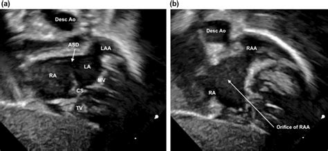 A B Juxtaposition Of The Right Atrial Appendage To The Left—subcostal Download Scientific