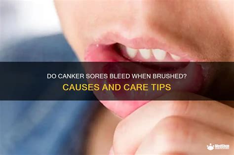 Do Canker Sores Bleed When Brushed Causes And Care Tips Medshun