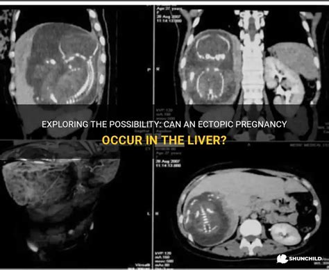 Exploring The Possibility Can An Ectopic Pregnancy Occur In The Liver