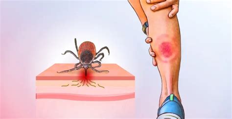 Tick Bite What To Do And Lyme Disease Risks News Directory 3