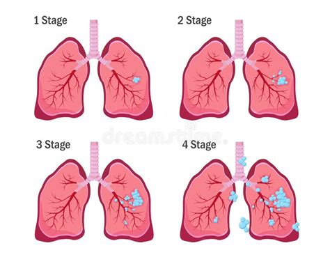 Stadia Van Kanker Stock Illustratie Illustratie Bestaande Uit Huid 28569340