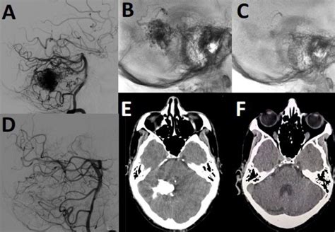 Ihtobtura A Novel Liquid Embolic Agent With Post Embolization Radiopacity Loss In Endovascular