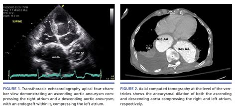 Thoracic Aortic Aneurysm Echocardiogram