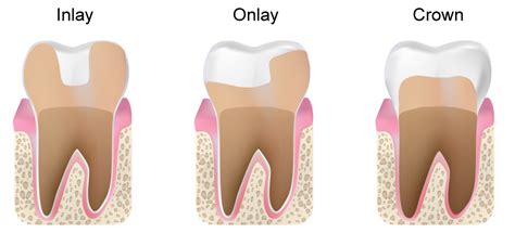 Inlays Et Onlays