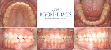 Before And After Beyond Braces Of Sachse Orthodontics