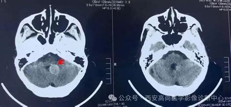 第四脑室室管膜瘤 知乎