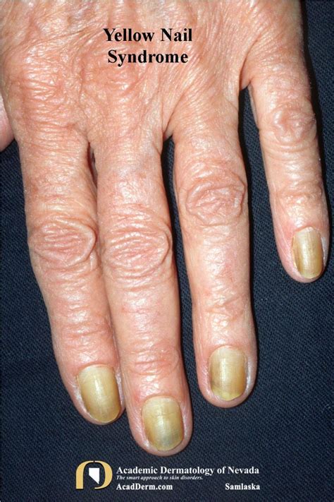 Yellow Nail Syndrome Yellow Nails Lymphedema Bronchiectasis Pleural