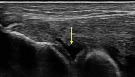 Musculoskeletal Joints And Tendons 62 Elbow Case 621 Common