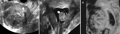 Submucosal Fibroid In A 41 Year Old Female Evaluated With Sis A