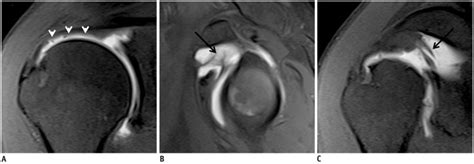 Partial Tear Of Undersurface Of Supraspinatus Tendon With Sghl Tear In