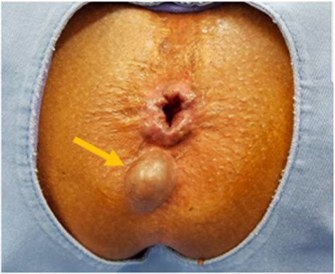Nodular Cystic Lesion In The Right Posterolateral Region Of The Anus