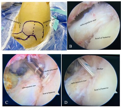 The Modified Single Working Portal Technique Using Lasso Loop Stitch