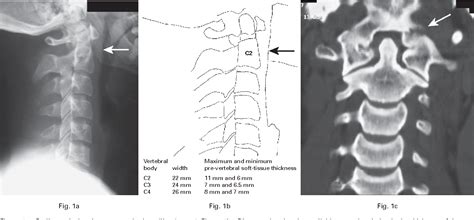Occipital Condylar Fractures A Review Zkrju