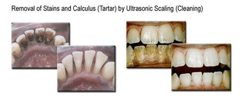 Scalingcleaning Dentaloral Surgery And Implant Clinic