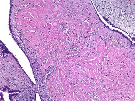 Breast Fibroadenoma Causes Symptoms Signs Diagnosis And Treatment