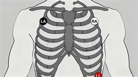 3 Lead Ecg Placement Fast Clean Step By Step Medlinket