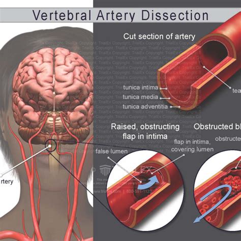What Is Dissection Of An Artery At Ella Gatliff Blog