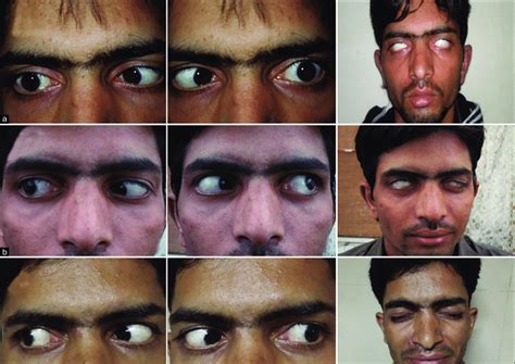 Abducens Nerve Palsy