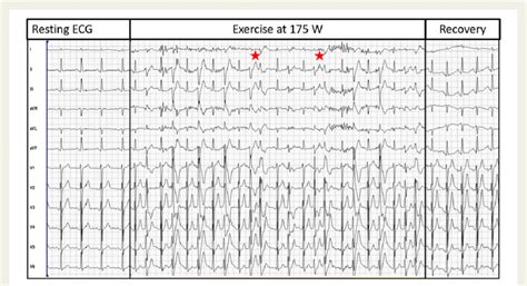 Exercise Electrocardiogram Of The Patient The Download Scientific
