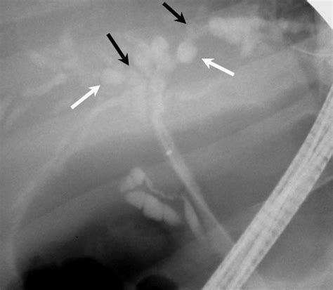 Primary Sclerosing Cholangitis Medlibes Online Medical Library